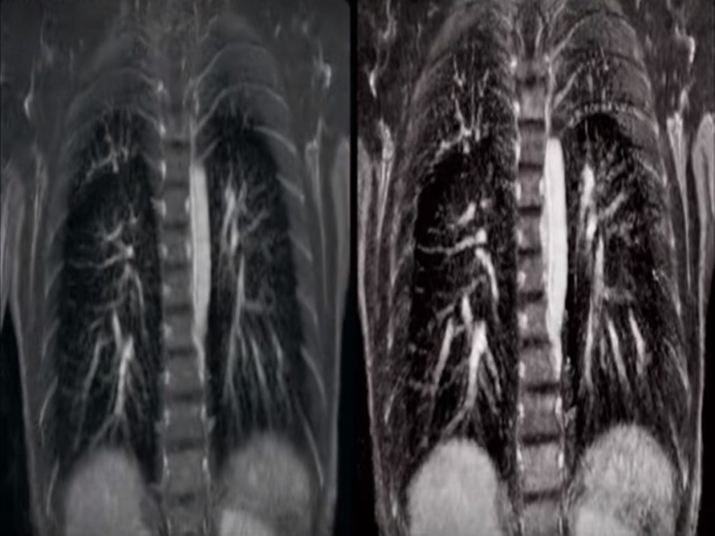 First Heartless Human In The World Live Without Pulse