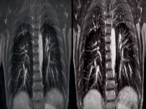 First Heartless Human In The World Live Without Pulse