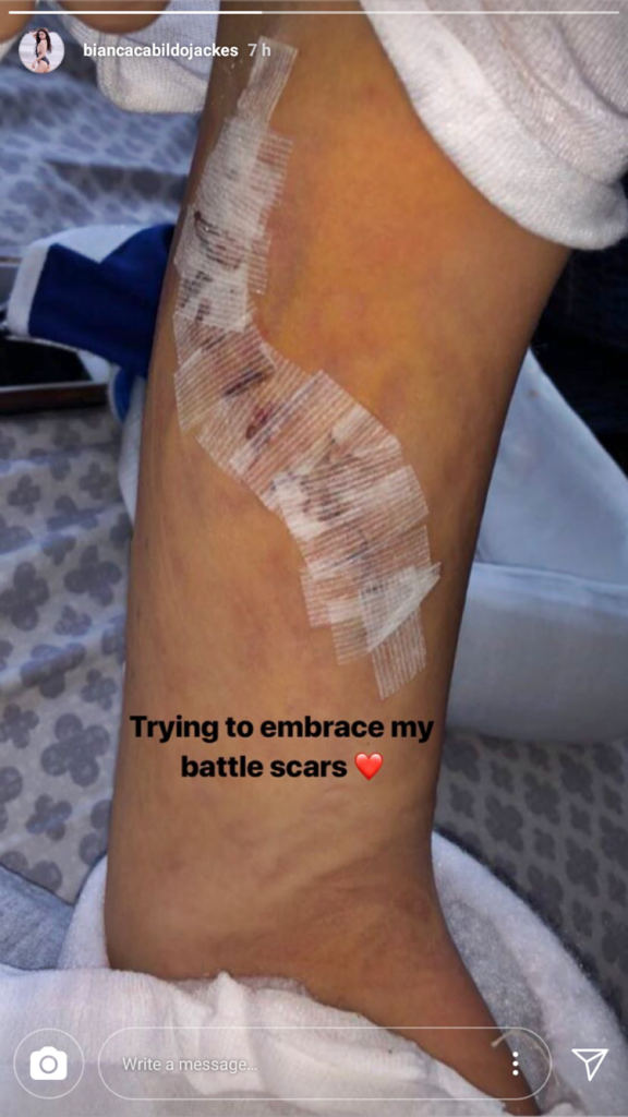 Bianca Jackes Shows Wound Caused By Mark Cardona Following Stabbing ...