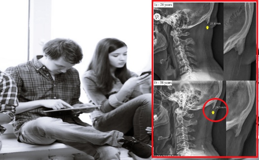 Mobile Phones Are Making Changes On The Human Skull