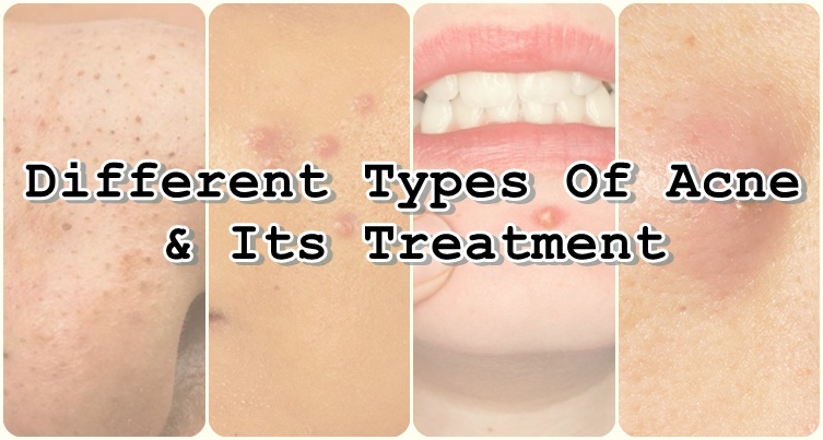 ACNE: Different Types Of This Face Condition & Its Treatment