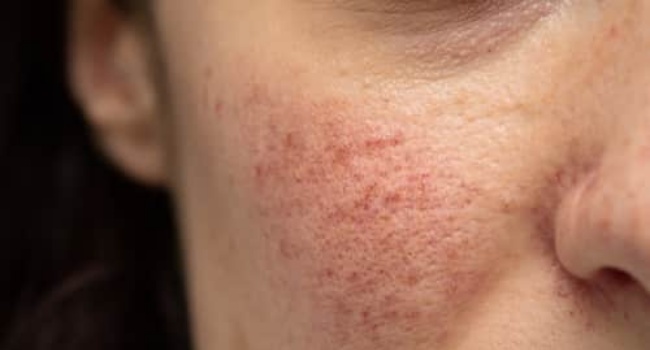 Rosacea - 5 Things You Need To Know About Those Flushed Cheeks