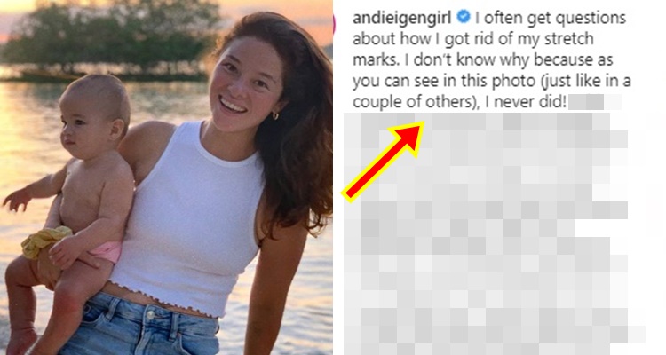 Andi Eigenmann Talks About Her Stretch Marks and How It Won't Go Away