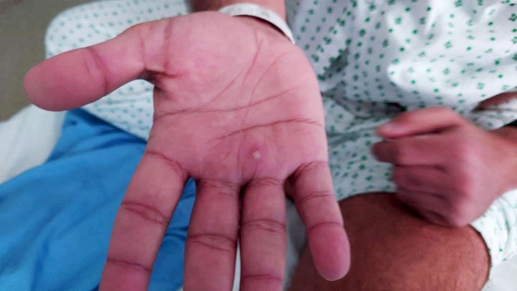 Monkeypox Symptoms: The List of Signs You Must Not Ignore