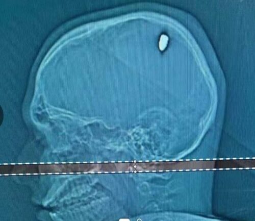 Student Partied for Four Days Unaware of Stray Bullet in His Head ...